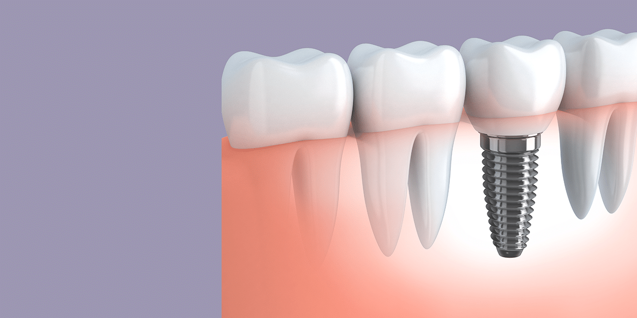 Replacing A Single Tooth - Dentist In Orange Park, FL